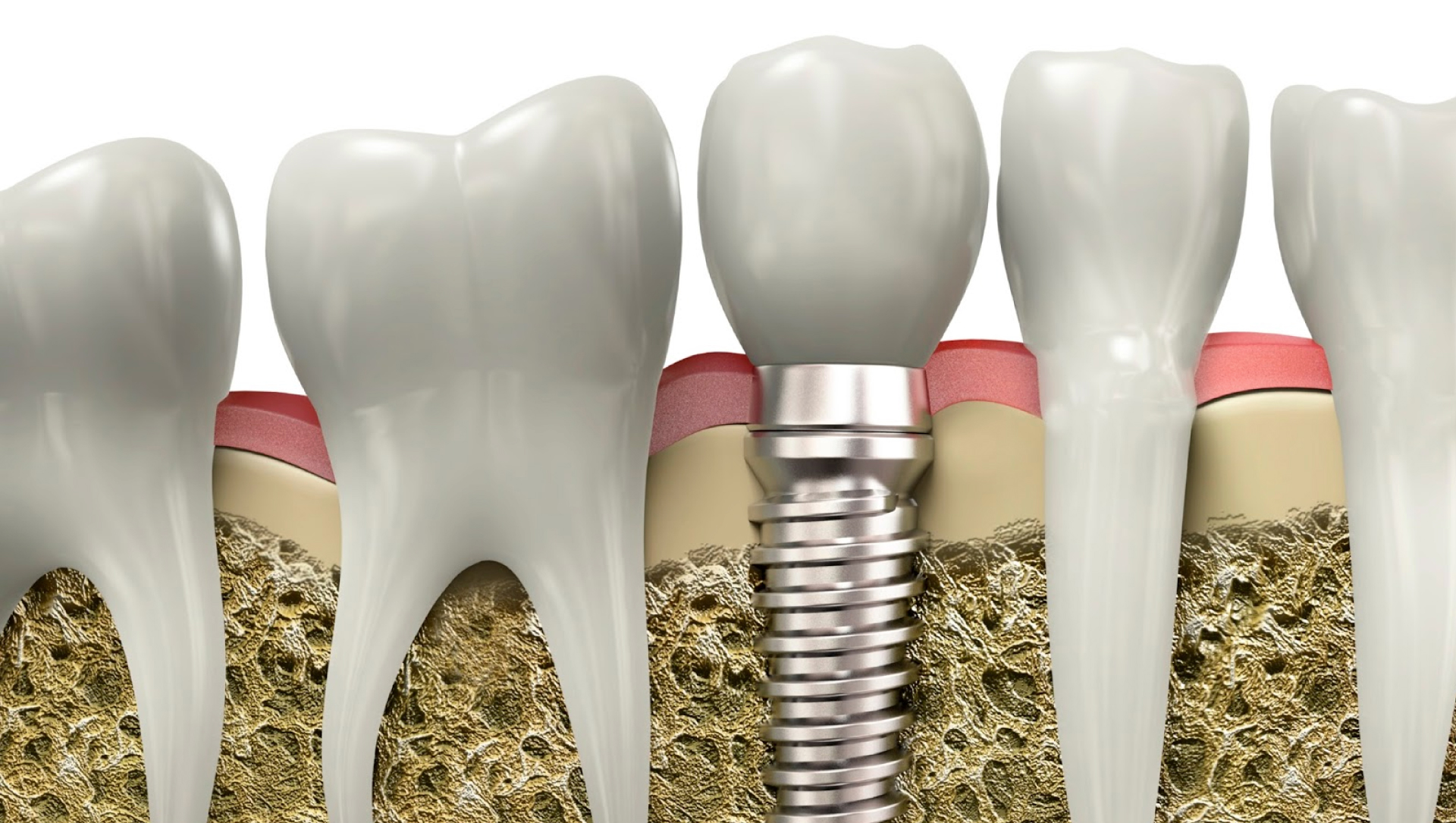 IMPLANTOLOGÍA ORAL | Implantes y Sonrisas